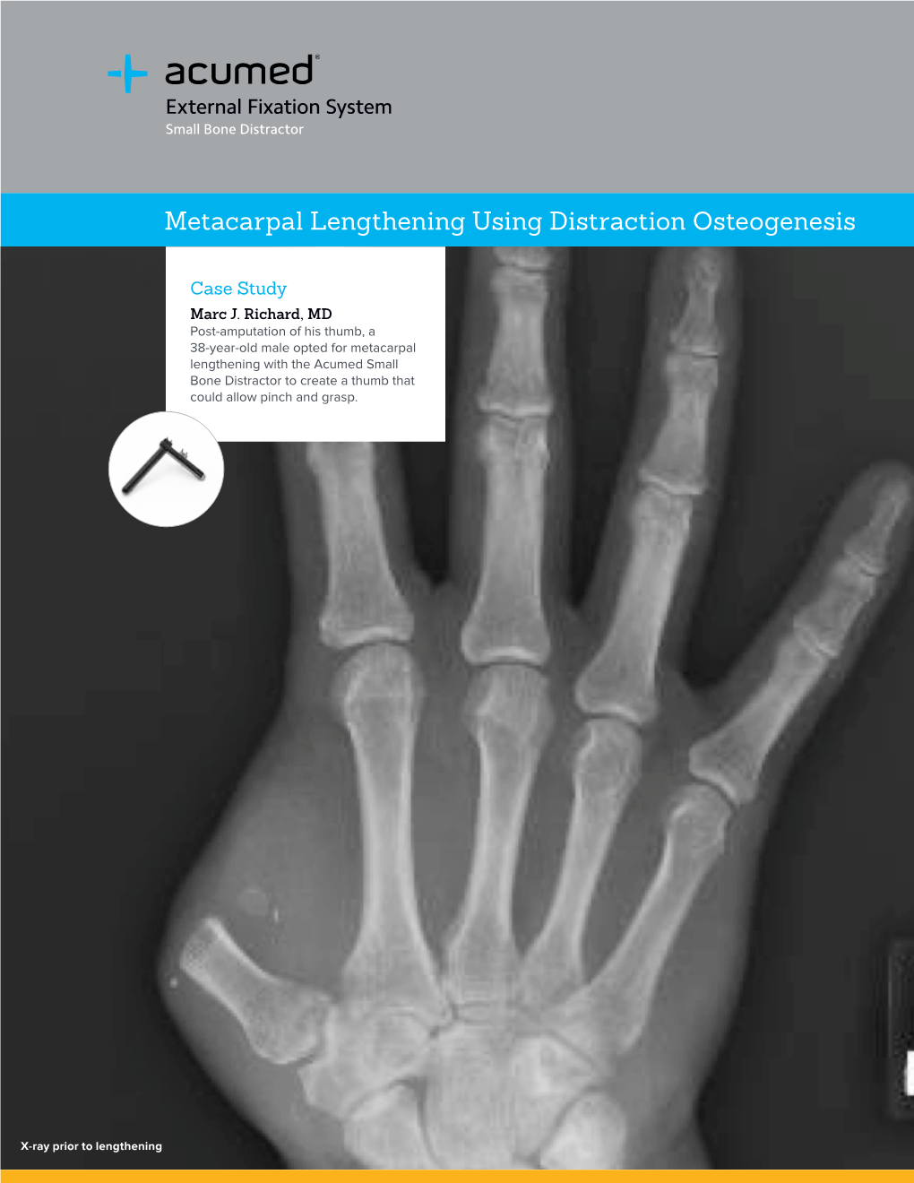 Metacarpal Lengthening Using Distraction Osteogenesis - DocsLib